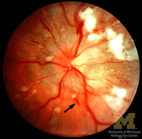 Systemic Hypertension : Systemic Conditions : The Eyes Have It