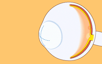 Refractive Disorders : Other Eye Conditions : The Eyes Have It