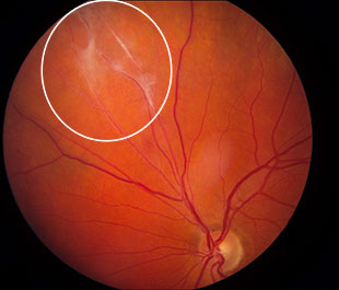 Behçet Disease : Systemic Conditions : The Eyes Have It