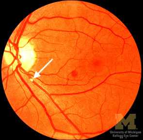 Retinal Calcific Embolus : Ophthalmoscopic Abnormalities : The Eyes Have It