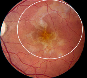 Choroidal Melanoma : Other Eye Conditions : The Eyes Have It