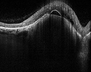 Choroidal Melanoma : Other Eye Conditions : The Eyes Have It