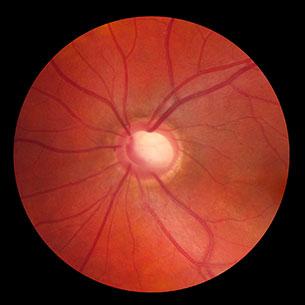 Pathologic Optic Disc Cupping : Ophthalmoscopic Abnormalities : The ...
