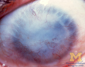Keratitis : Red Eye : The Eyes Have It