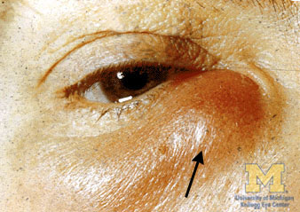 Dacryocystitis : Red Eye : The Eyes Have It