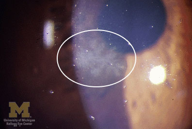 Corneal Abrasion : Eye Trauma : The Eyes Have It