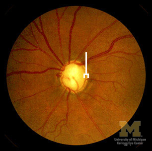 Pathologic Optic Disc Cupping : Ophthalmoscopic Abnormalities : The ...