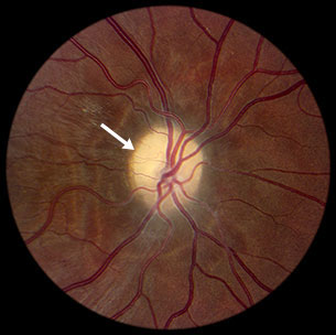 Optic Disc Pallor : Ophthalmoscopic Abnormalities : The Eyes Have It
