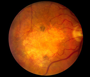Dry Age-related Macular Degeneration : Other Eye Conditions : The Eyes ...