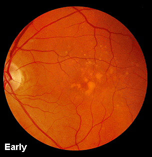 Dry Age-related Macular Degeneration : Other Eye Conditions : The Eyes ...