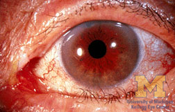 Tearing : Eye Symptoms & Signs : The Eyes Have It
