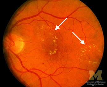 Retinal Hard Exudates : Ophthalmoscopic Abnormalities : The Eyes Have It