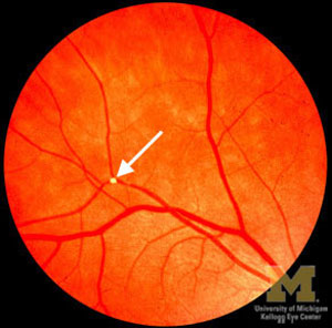 Retinal Platelet-fibrin (Hollenhorst) Embolus : Ophthalmoscopic ...