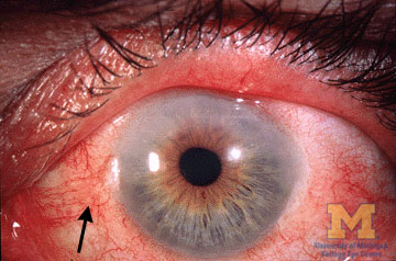 Immunogenic Conjunctivitis : Red Eye : The Eyes Have It