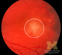 Retinal Infiltrate : Ophthalmoscopic Abnormalities : The Eyes Have It