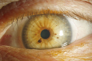 Iris Melanoma : Other Eye Conditions : The Eyes Have It