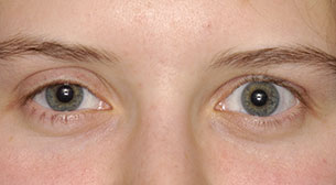 Ptosis : Eye Symptoms & Signs : The Eyes Have It