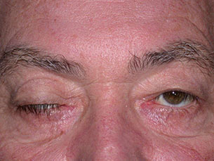 Diplopia : Eye Symptoms & Signs : The Eyes Have It