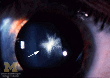 Myotonic Dystrophy : Systemic Conditions : The Eyes Have It