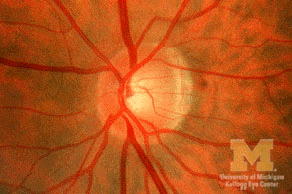 Optic Disc Pallor : Ophthalmoscopic Abnormalities : The Eyes Have It