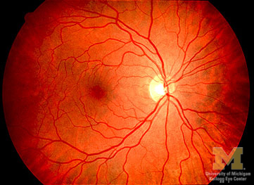 Retinal Neovascularization : Ophthalmoscopic Abnormalities : The Eyes ...