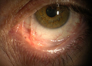 Immunogenic Conjunctivitis : Red Eye : The Eyes Have It