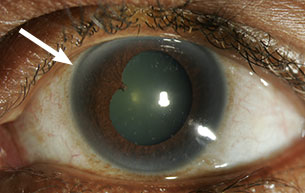 Anterior Uveitis (Iritis) : Red Eye : The Eyes Have It