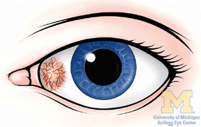 Episcleritis : Red Eye : The Eyes Have It