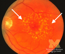 Yellow White Things in the Retina : Ophthalmoscopic Abnormalities : The ...