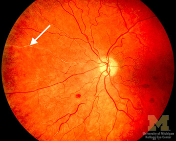 Old Retinal Vascular Occlusion : Ophthalmoscopic Abnormalities : The ...