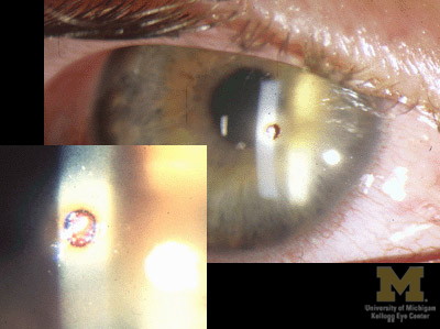 Corneal Foreign Body : Eye Trauma : The Eyes Have It