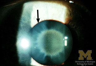 Wilson Disease : Systemic Conditions : The Eyes Have It