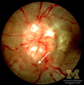 Congenitally Elevated Optic Disc Anomaly : Ophthalmoscopic ...
