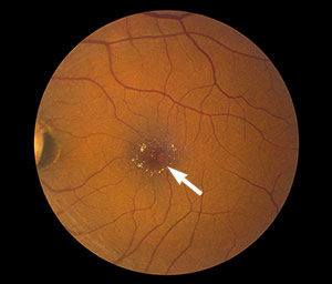 Tamoxifen : Side Effects of Medications : The Eyes Have It