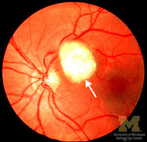 Tuberous Sclerosis Complex : Systemic Conditions : The Eyes Have It
