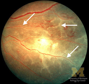 Retinal Vasculitis : Ophthalmoscopic Abnormalities : The Eyes Have It