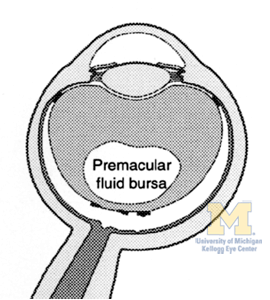 Vitreous Detachment : Other Eye Conditions : The Eyes Have It